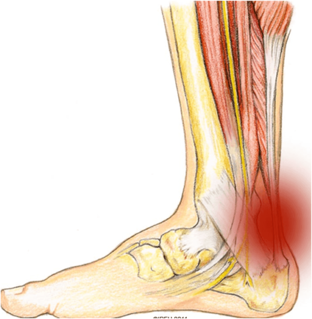 Tendinitis - causas, síntomas y tratamiento - ViviendoSanos.com
